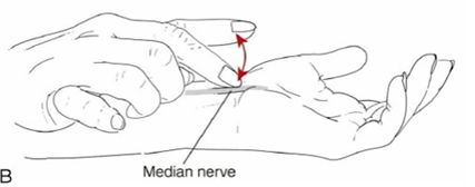 커뮤니티 > 피아니스트 질환 1. 손목터널증후군(carpal tunnel syndrome)